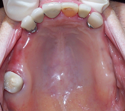 Clear Frame Maxillary Partial Denture - Landmark Dental