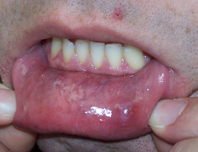 Case3 Biopsy of the Lower Lip – Molecule - Landmark Dental