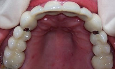 Case5 Full Mouth Reconstruction: Intracoronal Precision