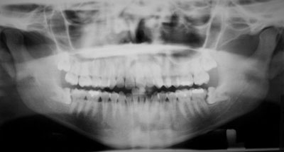 Impacted Teeth - Landmark Dental in Norwood MA
