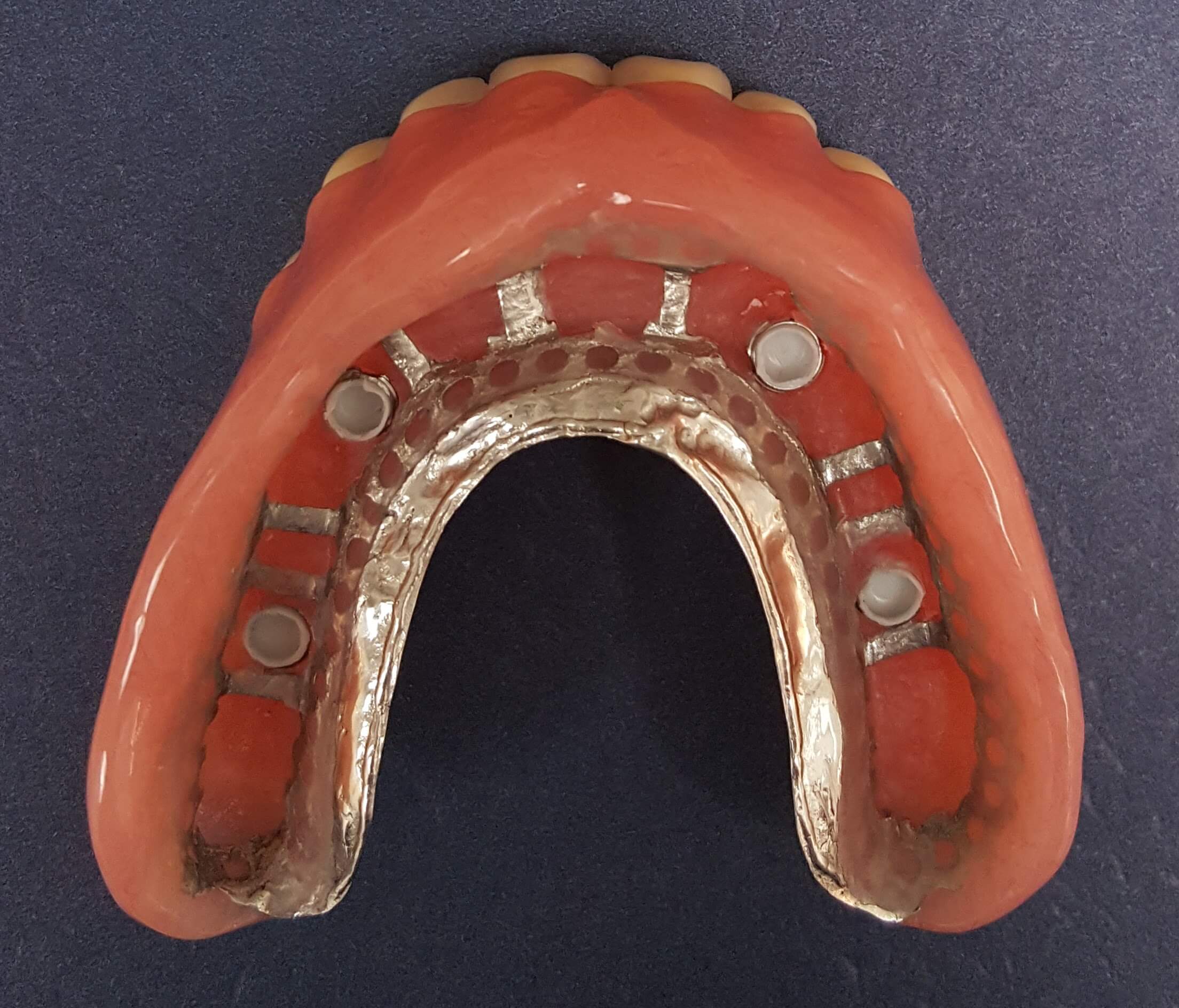 Case #13: Titanium Bar Supported Maxillary Complete Denture