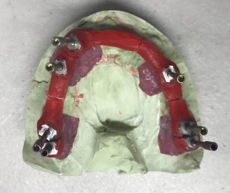 Case #13: Titanium Bar Supported Maxillary Complete Denture