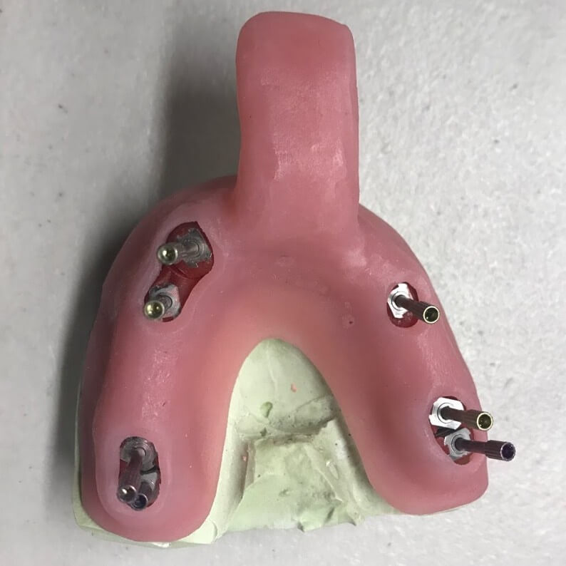 Case #13: Titanium Bar Supported Maxillary Complete Denture