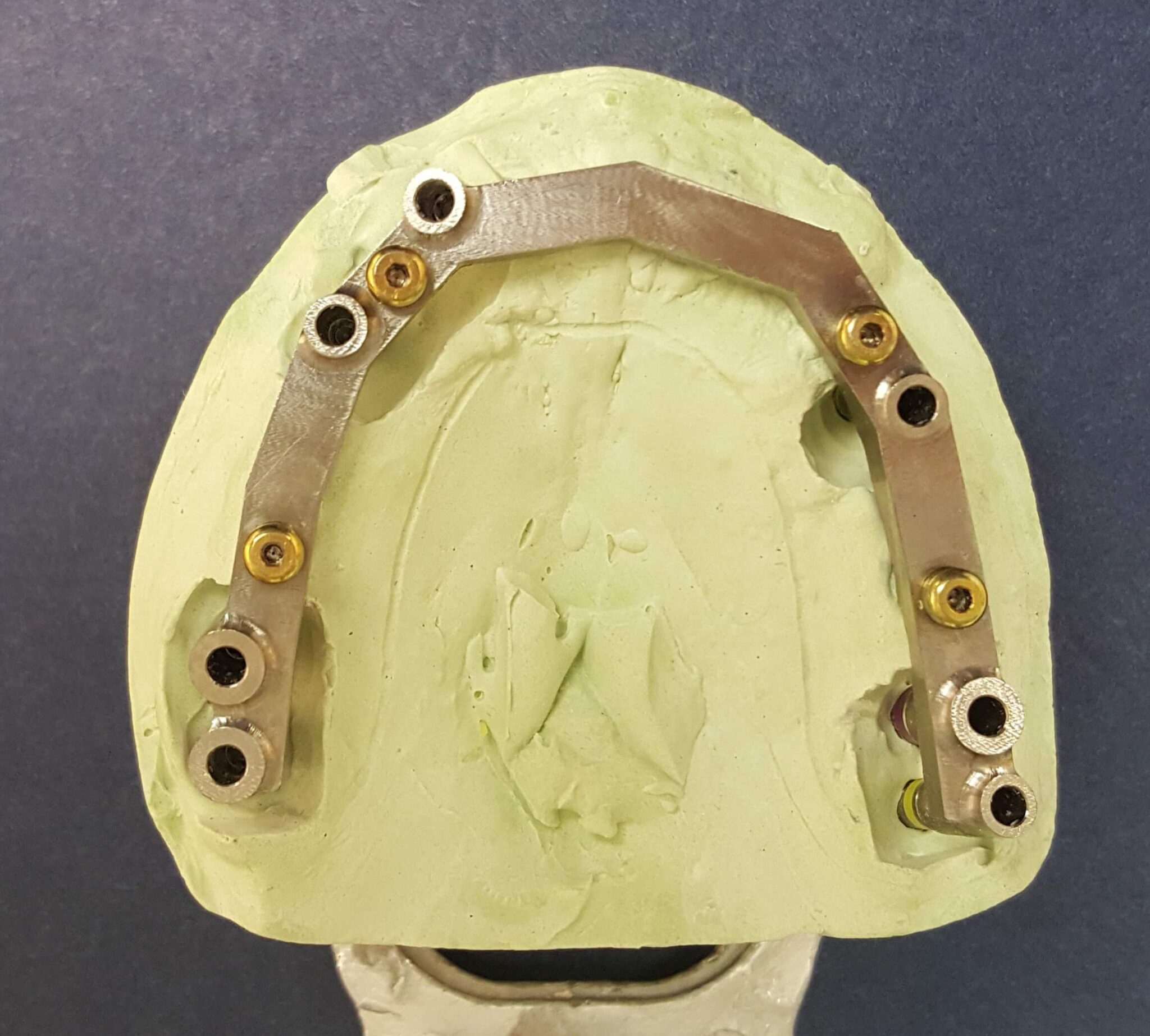 Case #13: Titanium Bar Supported Maxillary Complete Denture