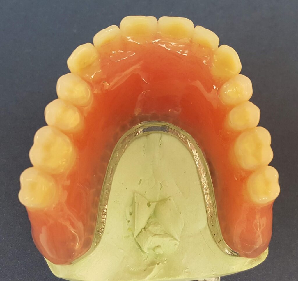 Case #13: Titanium Bar Supported Maxillary Complete Denture