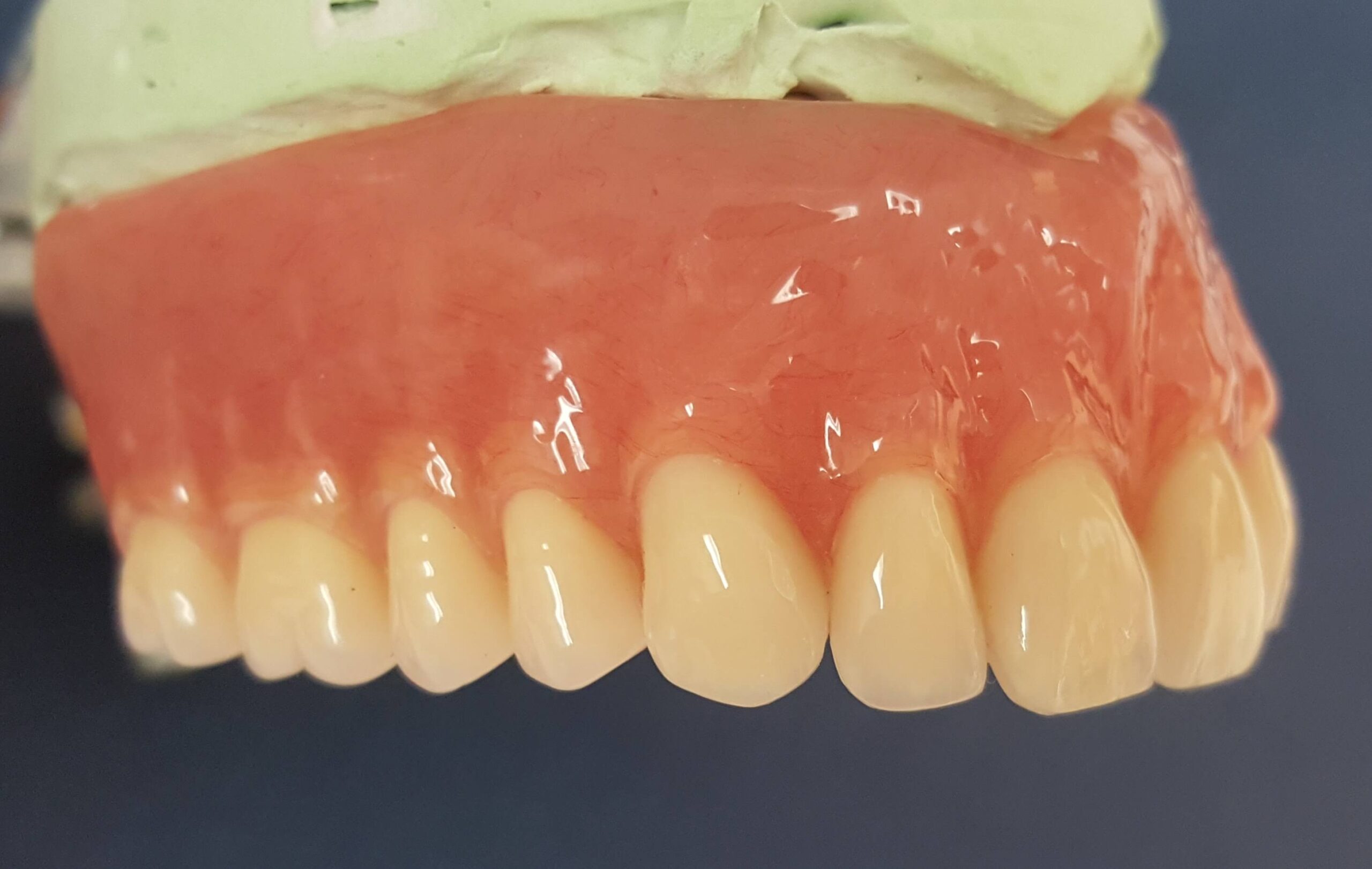 Case #13: Titanium Bar Supported Maxillary Complete Denture