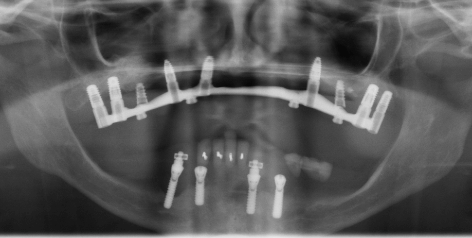 Case #13: Titanium Bar Supported Maxillary Complete Denture